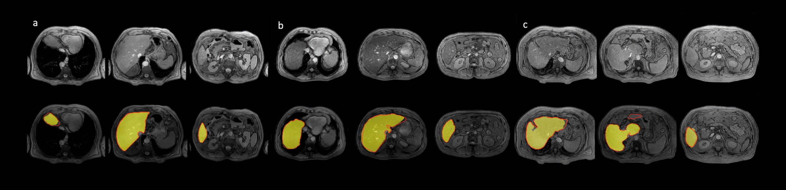 Advancing Liver Disease Assessment In Automatic Liver Segments 