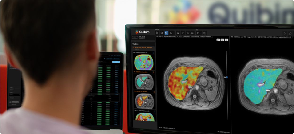 Personalized liver segmentation based on AI - QP-Liver®